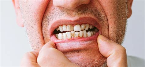 Early Gingivitis Symptoms 1064x599