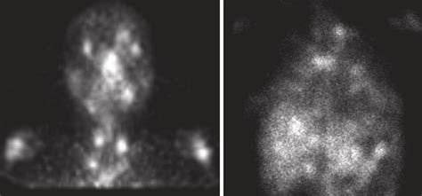 Spect Gallium Scan Displaying Increased Radiotracer Activity A In The Download Scientific