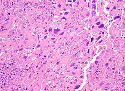 Endometrioid Carcinoma Of The Uterus Light Micrograph Stock Image C057 7186 Science Photo