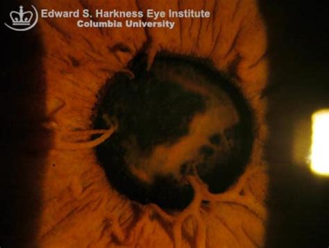 Persistent Pupillary Membrane Vagelos College Of Physicians And Surgeons