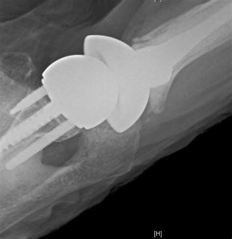 Uw Shoulder And Elbow Academy Scapular Spine And Acromial Fractures After Reverse Total