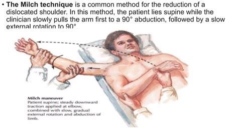 Shoulder Dislocationpptx