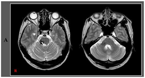Trigeminal Nerve Mri Sagittal