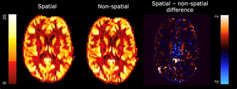 Perfusion Maps Derived From Single Delay Pseudo Continuous Asl With