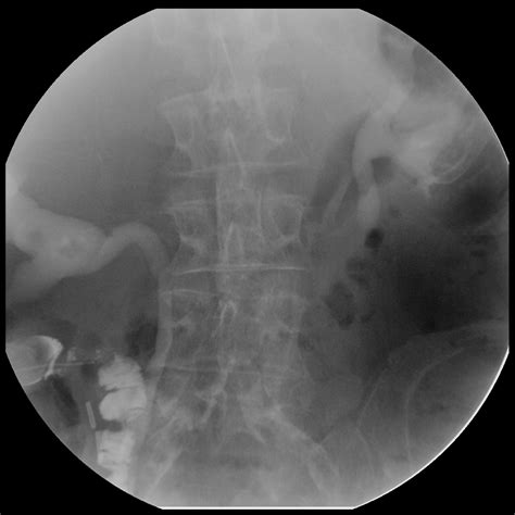 Topics In Radiography Loopogram