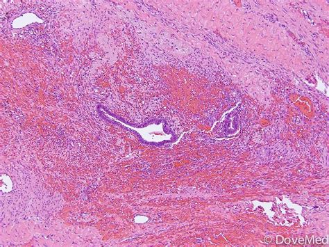Endometriosis Of Appendix Dovemed