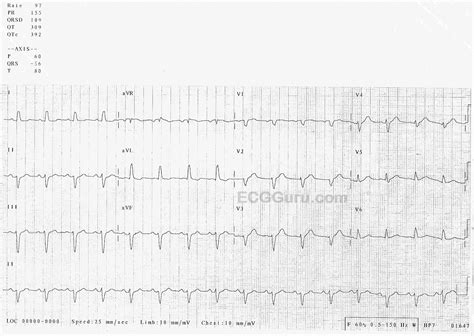 Intraventricular Conduction Delay Ecg Guru Instructor Resources