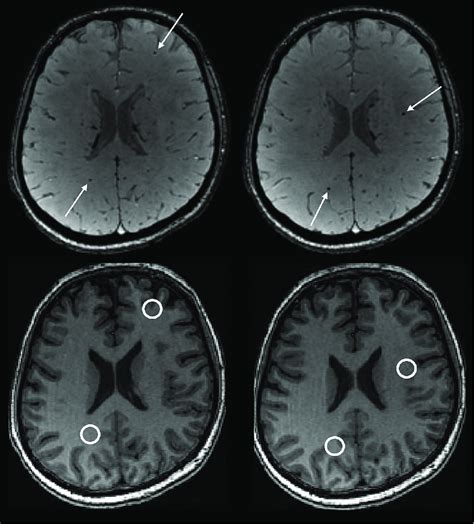 Upper Row Example Of Parenchymal Swi Hypointense Lesions In A