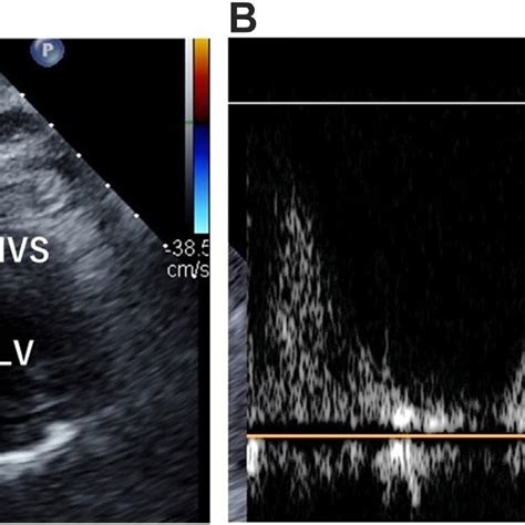 postoperative color flow and pulsed wave doppler echocardiography