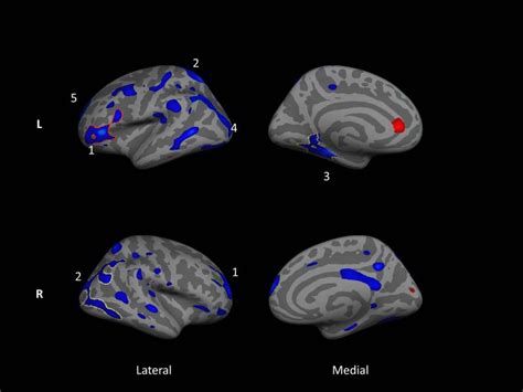Cerebral Perfusion And Cortical Thickness Indicate Cortical Involvement In Mild Pd Pmc