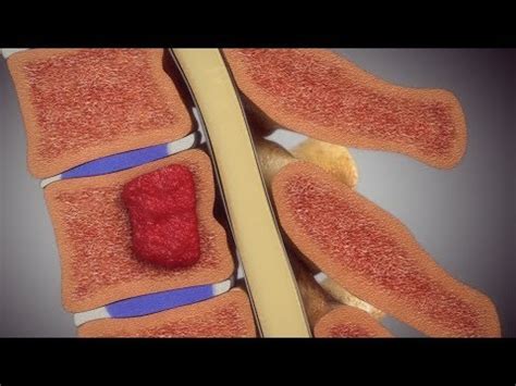 Spine Injury Animation With Hemangioma Youtube