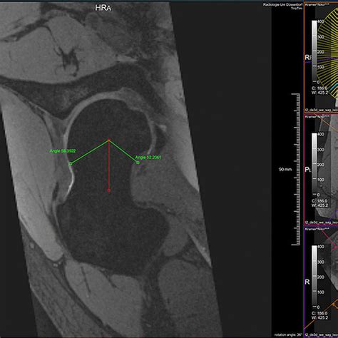 Automated Alpha Angle Measurement Using Automated Computer Based Download Scientific Diagram