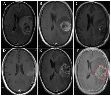Ai Driven Classification Of Diffuse Gliomas Skips Molecular Testing • Healthcare In