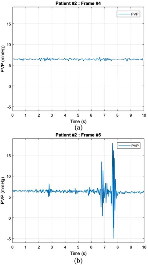 Waveform Examples Of A Good Frame 4 And A Motion Artifact Corrupted Download Scientific
