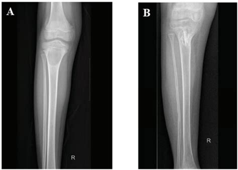 Surgispon® Assisted Surgery For Aneurysmal Bone Cyst In Proximal Tibia