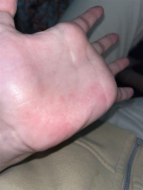 What Is This Bumpy Rash On My Hands R Medical Advice