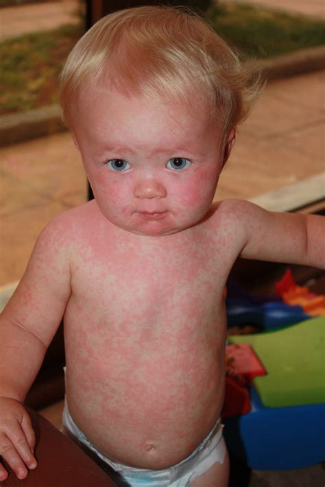 Daily Blog Diagnosis Roseola
