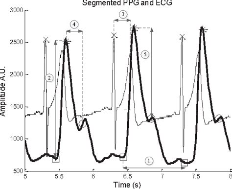 Figure 2 From An Automatic Method For Motion Artifacts Detection In Photoplethysmographic