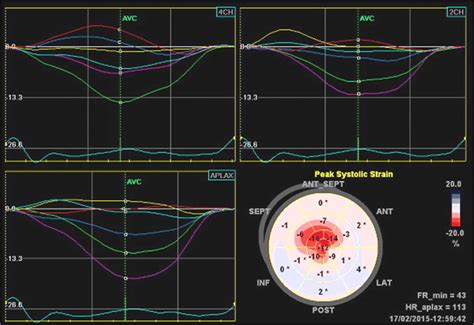 Speckle Tracking Global Longitudinal Strain In A Patient With Attr Download Scientific Diagram