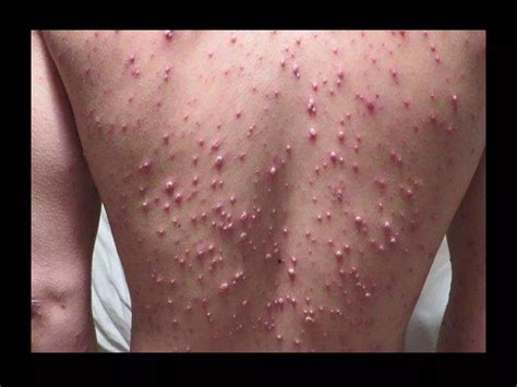 Herpes Simplex Virus Hsv And Varicella Zoster Virus Vzv By Dr