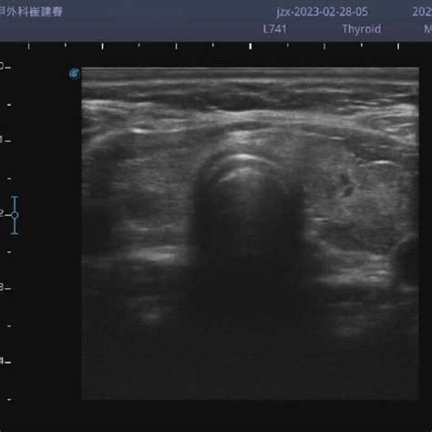 Hashimotos Hyperthyroid Stage Download Scientific Diagram