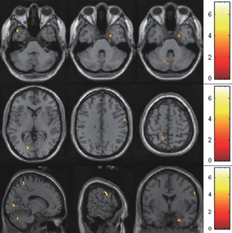 Figure 1 From Age‐related White Matter Degradation Rule Of Normal Human