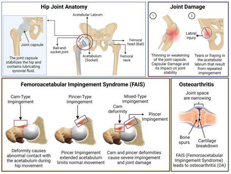 Outcomes And Complications Of Hip Arthroscopy For Femoroacetabular