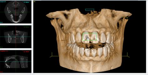 Cone Beam Dental X Ray The Best Picture Of Beam