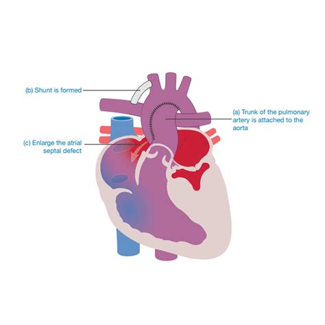 Hypoplastic Left Heart Syndrome Little Hearts Matter