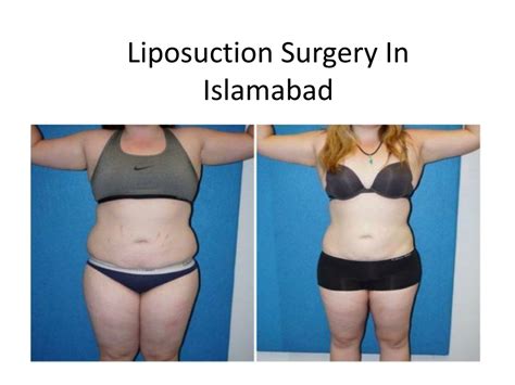 Ppt Liposuction Surgery In Islamabad Powerpoint Presentation Free