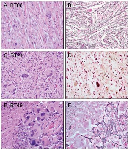 A Hande Stained Section Of A Pleomorphic Xanthoastrocytoma Pxa Bt06