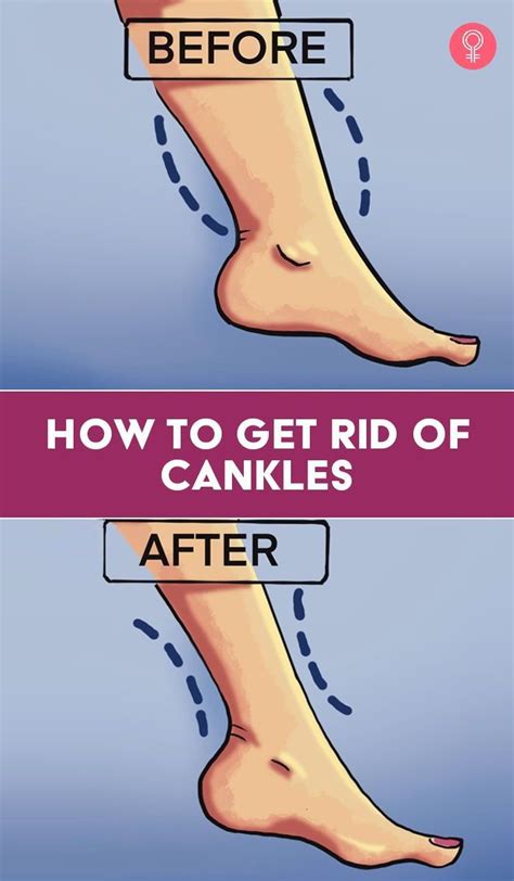 3 Reasons People Have Thick Ankles Artofit