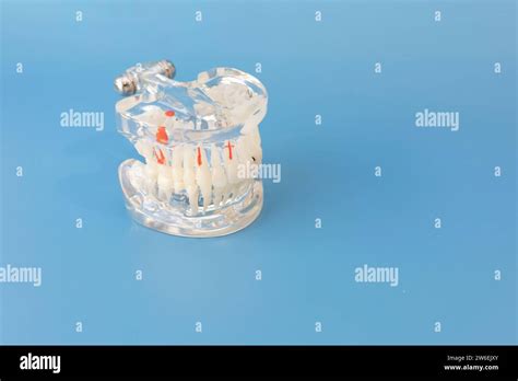 Study Standard Typodont Or Periodontal Disease Teeth Model For