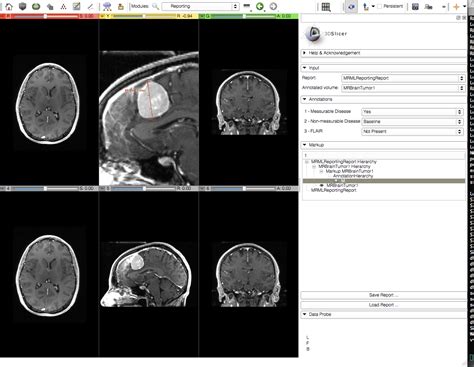 Projectsqin3d Slicer Annotation Image Markupdesign And