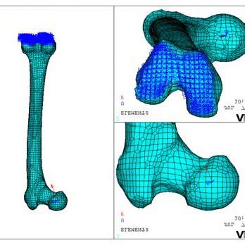The Femur Finite Element Model With Loading And Boundary Conditions Download Scientific Diagram