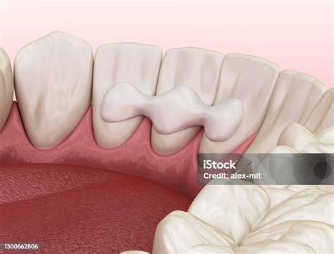 세라믹 전두엽 치아 회복으로 만든 메릴랜드 다리 치과 개념의 의학적으로 정확한 3d 일러스트 건강관리와 의술에 대한 스톡 사진 및 기타 이미지 Istock