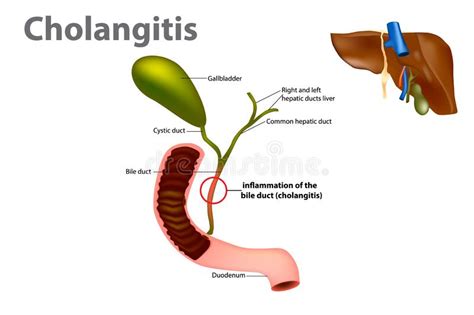 Cholangitis Triad