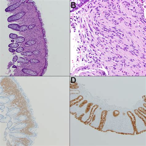 Fibrous Obliteration Of The Appendix A Central Obliterative Lesion
