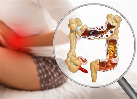 What Causes Ulcers In The Lower Colon