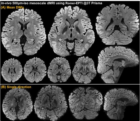 In Vivo Whole Brain Distortion Free 500μm Isotropic Mesoscale Diffusion