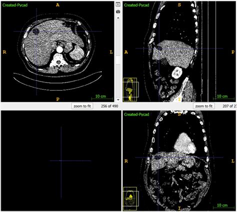 Decoding Ct Scans Simplifying Window Settings Pycad Your Medical