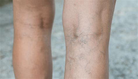 Understanding Venous Thrombosis A Silent Killer Worldwide Arabtimes