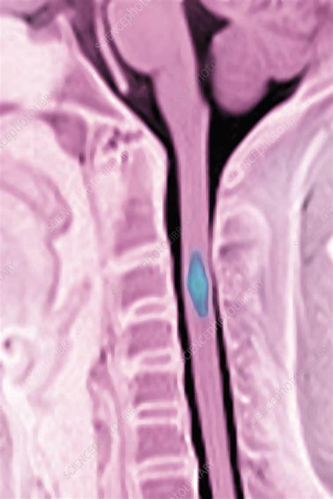 multiple sclerosis mri stock image c058 4683 science photo library