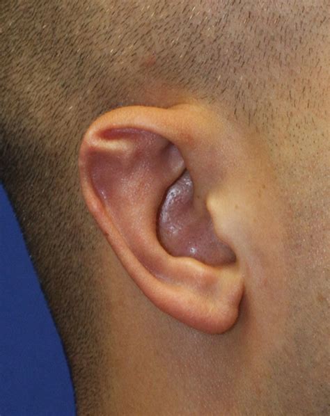 Stahl Ear Deformity Correction Case Study Seattle Facial Plastic