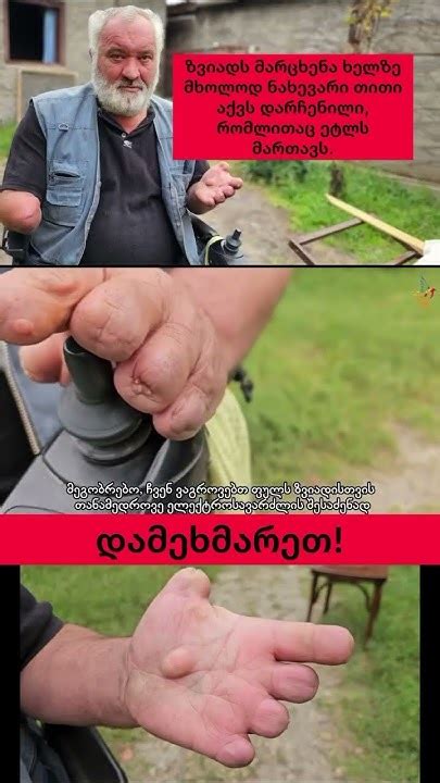 🙏 მეთოთხმეტე ოპერაციის შემდეგ ამ ადამიანს არც ხელები აქვს არც ფეხები ეტლიც კი არ გააჩნია