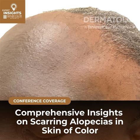 Follicular Hyperkeratosis Archives Next Steps In Dermatology