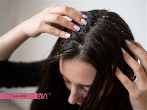 Common Scalp Conditions And Treatments Remotederm