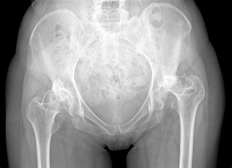 Hip Dysplasia Developmental Dysplasia Of The Hip Ddh The Scrub
