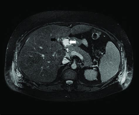 Mr Cholangiopancreatography Image A Thick Black Arrow Marks The Download Scientific Diagram