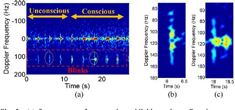 Figure 1 From Detection Of Eye Blinking Using Doppler Sensor With